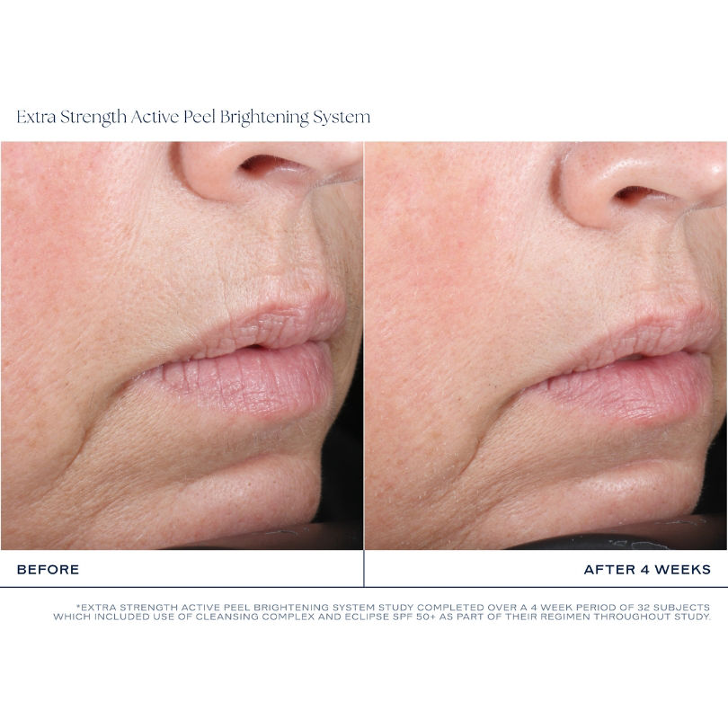 extra-strength-active-peel-brightening-system - TOP CLINIC - Kosmetolog ...